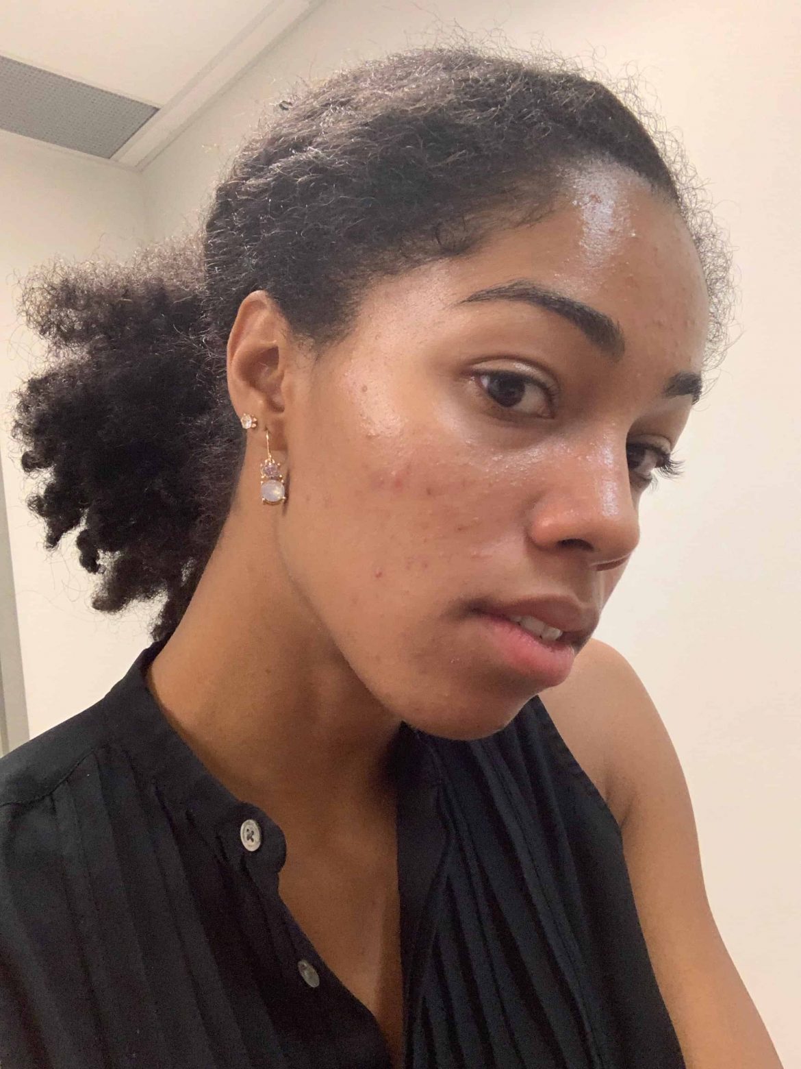 The Ordinary Skincare Regimen for Brown, Acne-Prone Skin