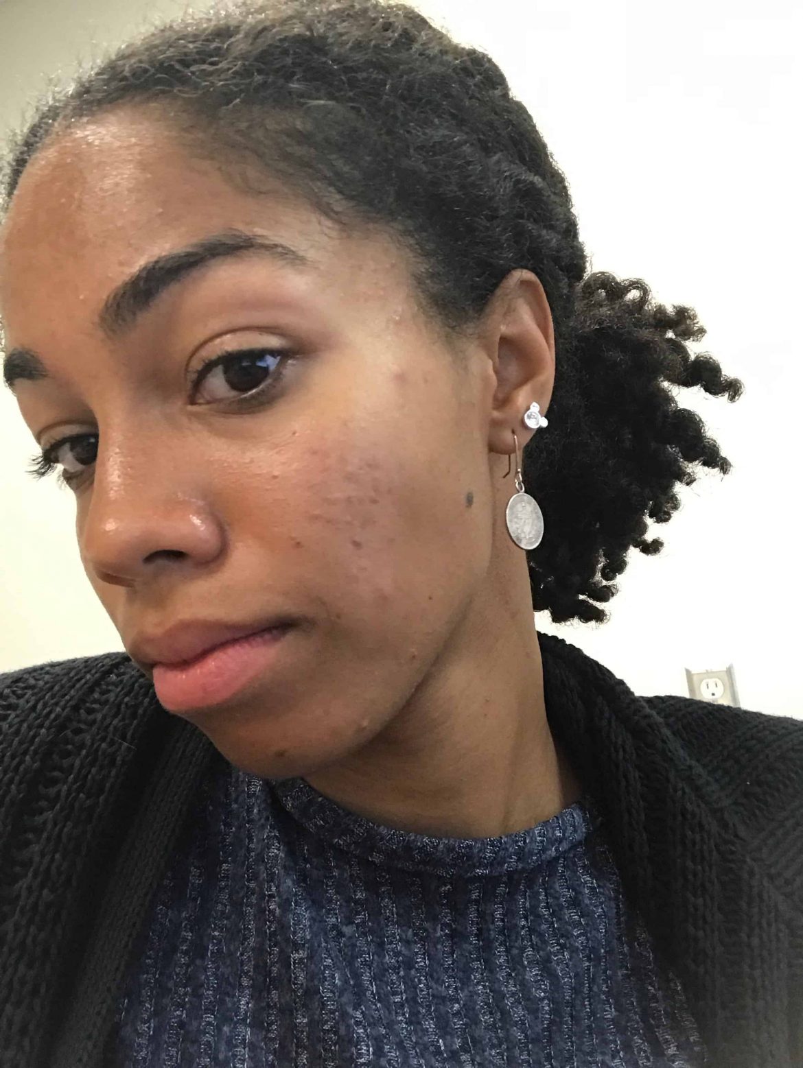 The Ordinary Skincare Regimen for Brown, Acne-Prone Skin
